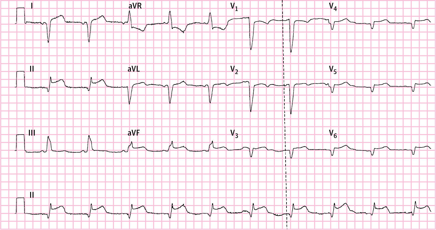 ECG