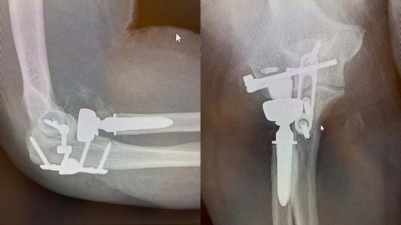 Case Study: Terrible Triad Right Elbow Fracture Dislocation