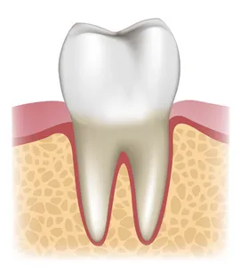 Karies: Symptome, Stadien & Behandlung - Zahnarzt Dr. Kraus