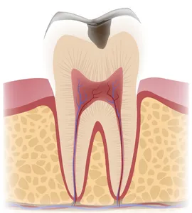 Karies: Symptome, Stadien & Behandlung - Zahnarzt Dr. Kraus