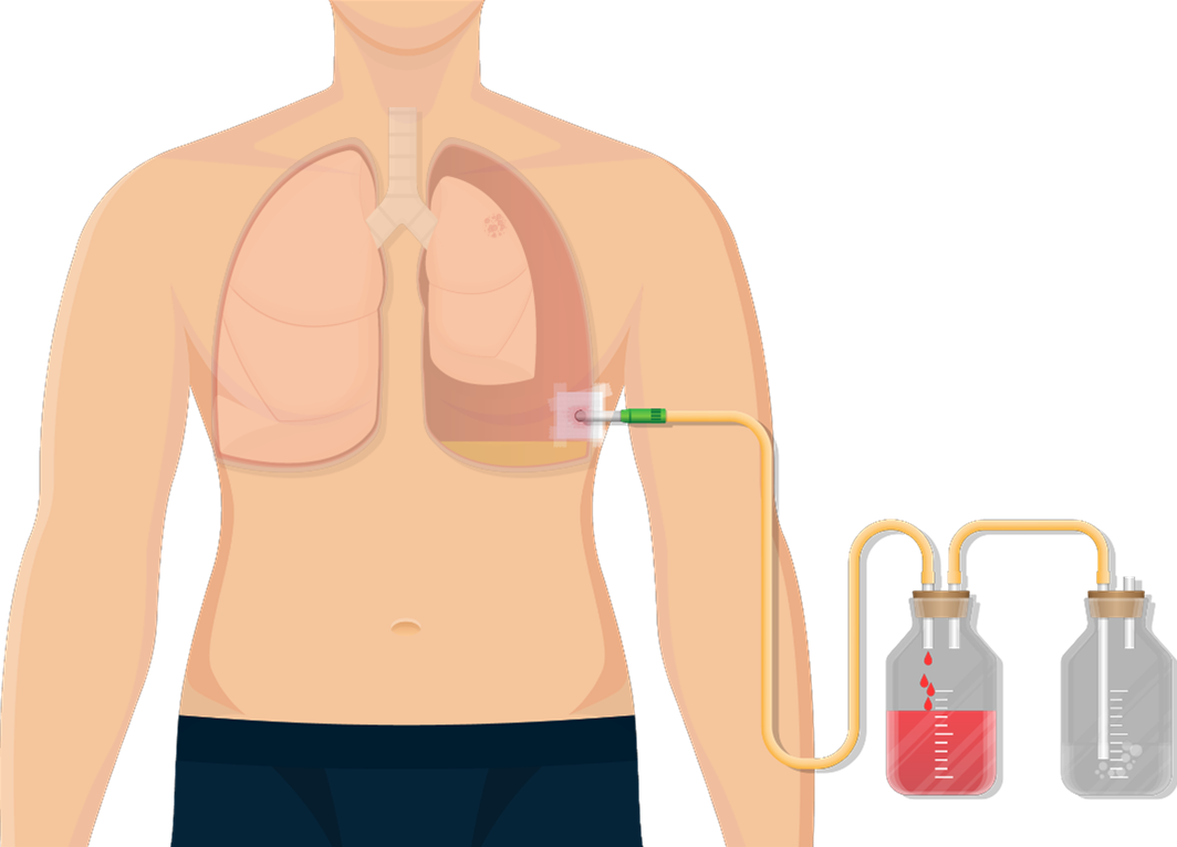 Chest tubes and under water seal drains: Nursing management | HealthStaffEd