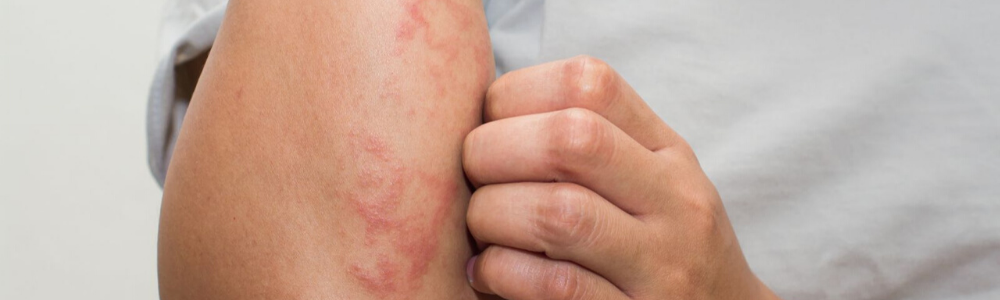 What Are Hives and What Causes Them?