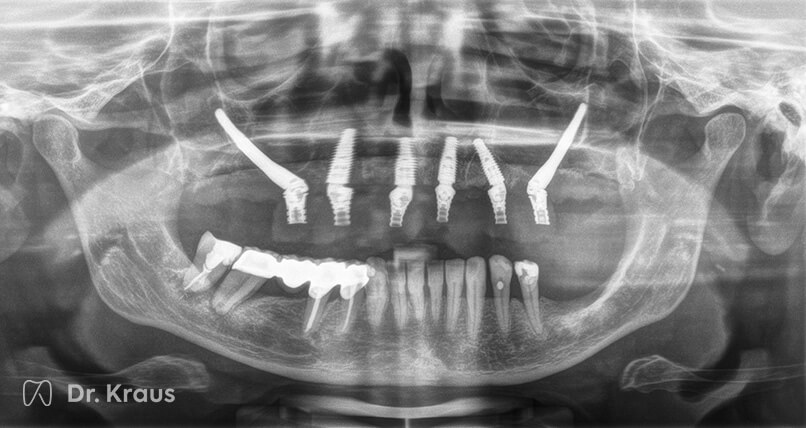 Al- on-4 Vorher-Nacher-Bilder » 47 Fotos von Zahnimplantaten