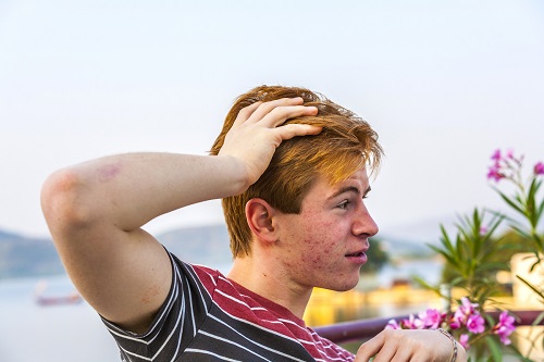 Acne and Genetics | Acne Hereditary | Genomelink