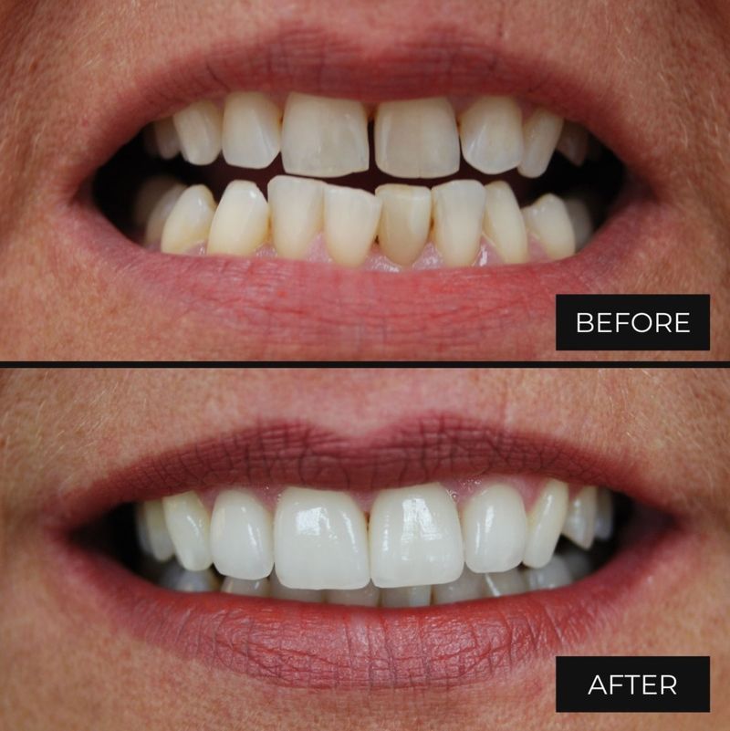 Composite Veneers - Everything You Need to Know