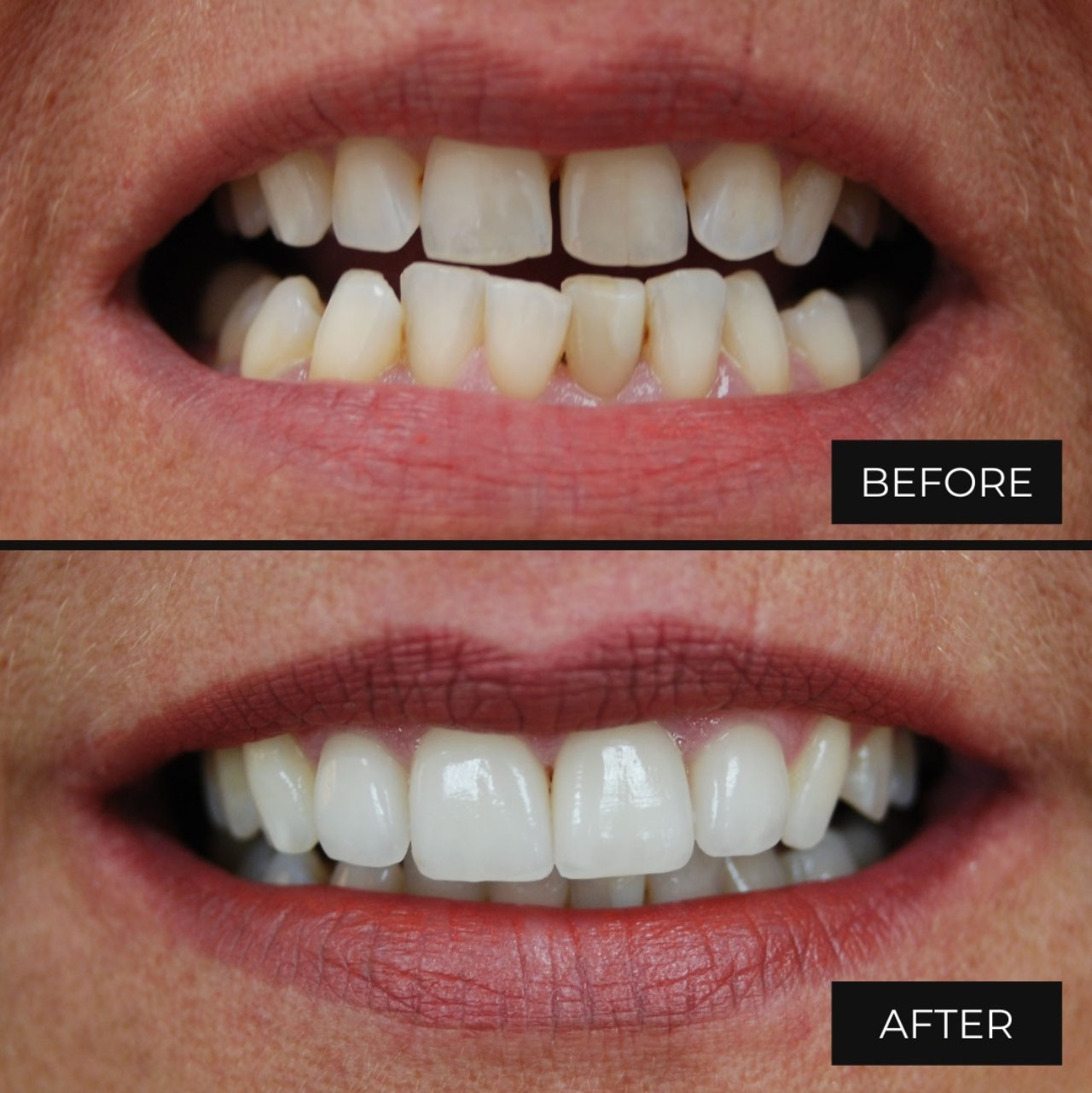 Porcelain Veneers Treatment - Birmingham