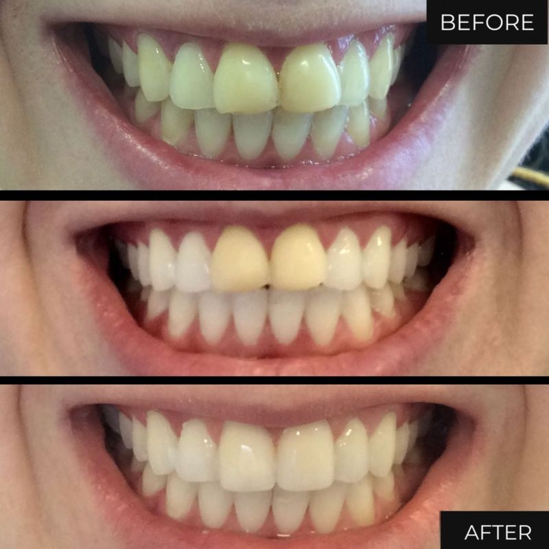 Composite Veneers - Everything You Need to Know