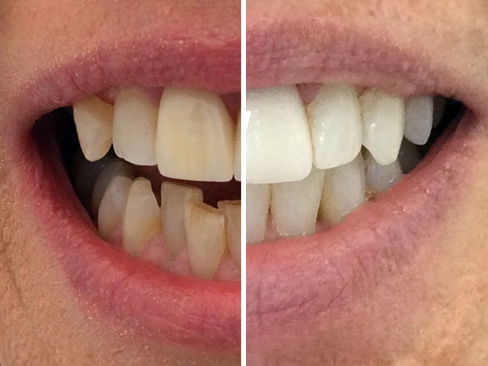 Diamond Invisalign Birmingham