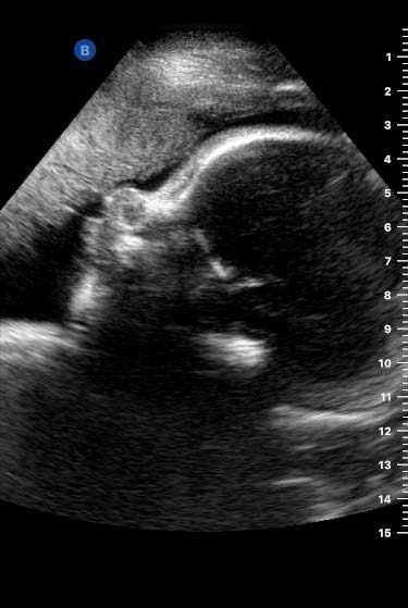 OB/GYN - Clinical Gallery - Butterfly iQ