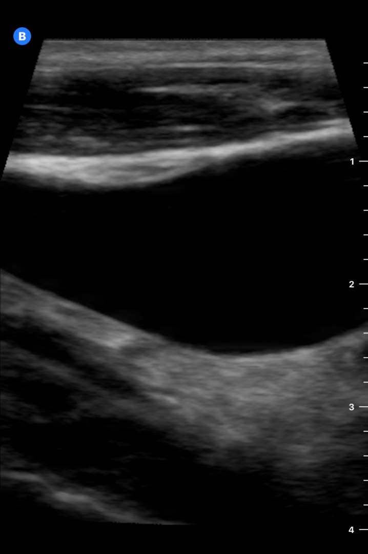 Vascular: Deep Vein - Clinical Gallery - Butterfly iQ