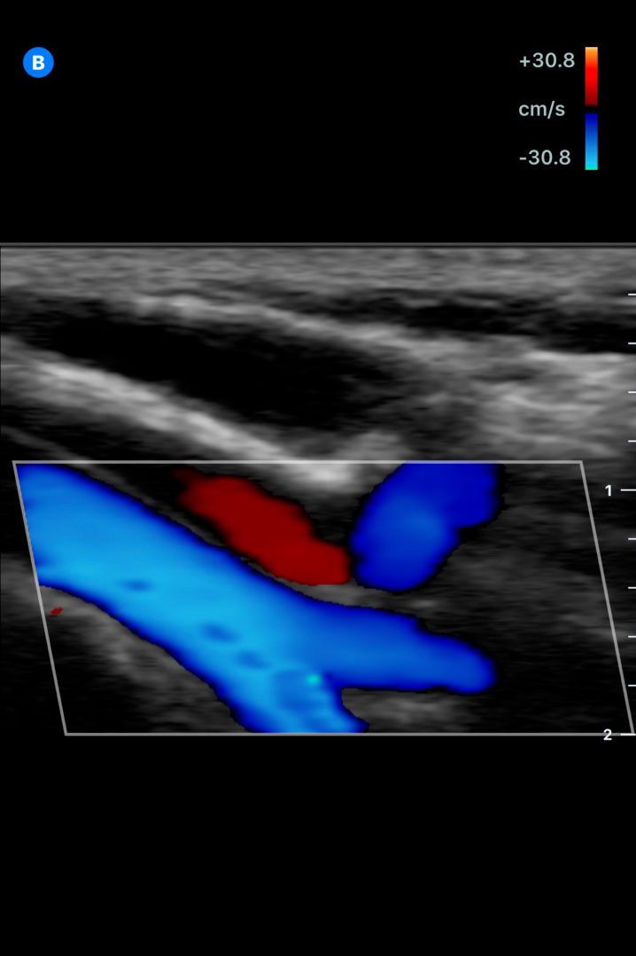 Vascular Access - Clinical Gallery - Butterfly iQ
