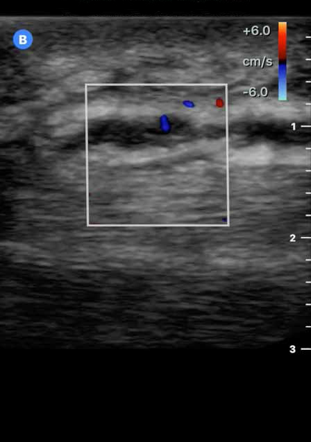 MSK–Soft Tissue - Clinical Gallery - Butterfly iQ