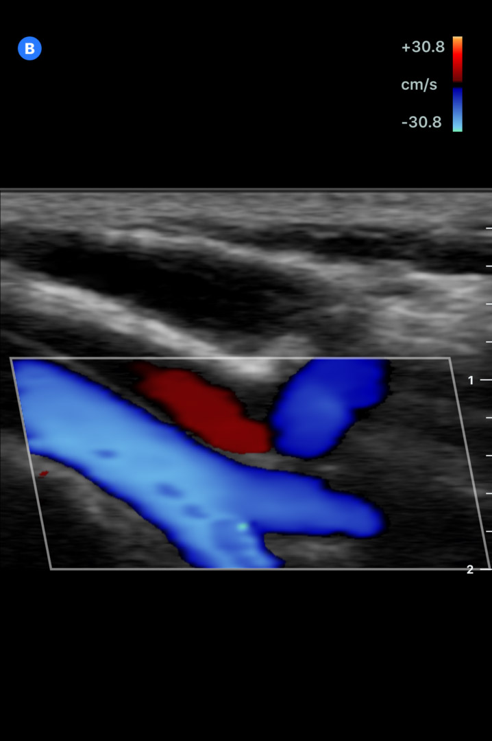 Vascular: Deep Vein - Clinical Gallery - Butterfly iQ