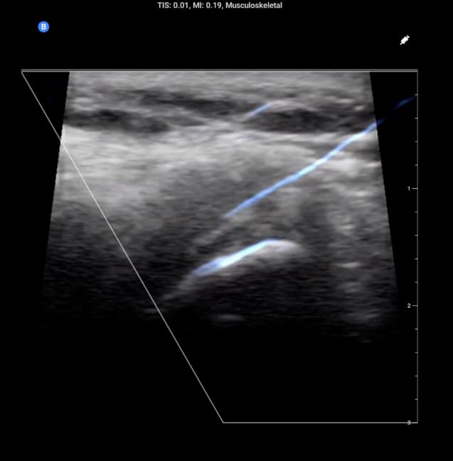 Musculoskeletal - Clinical Gallery - Butterfly iQ