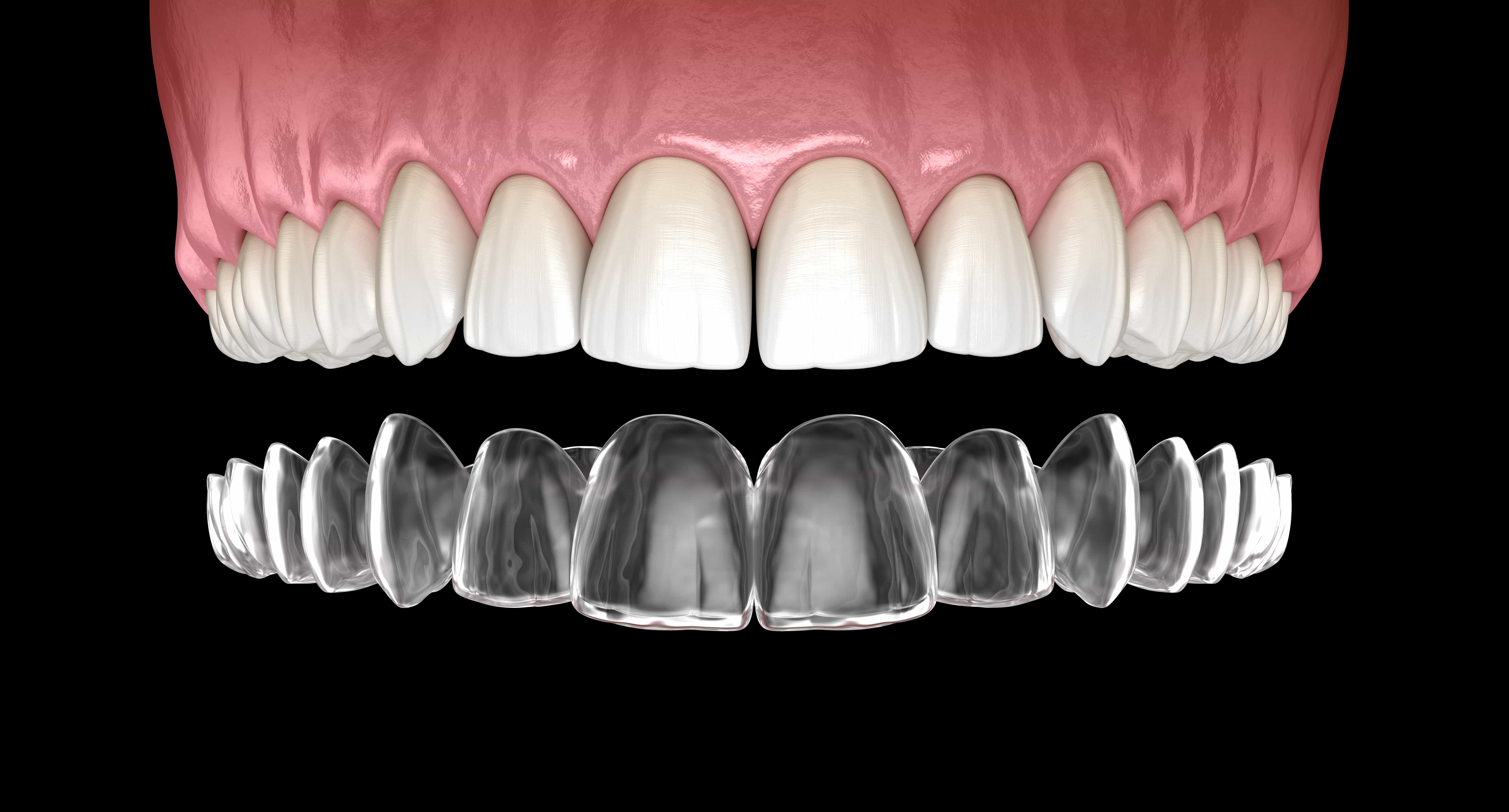 Invisalign in Pasadena, Altadena, Arcadia & Glendale CA