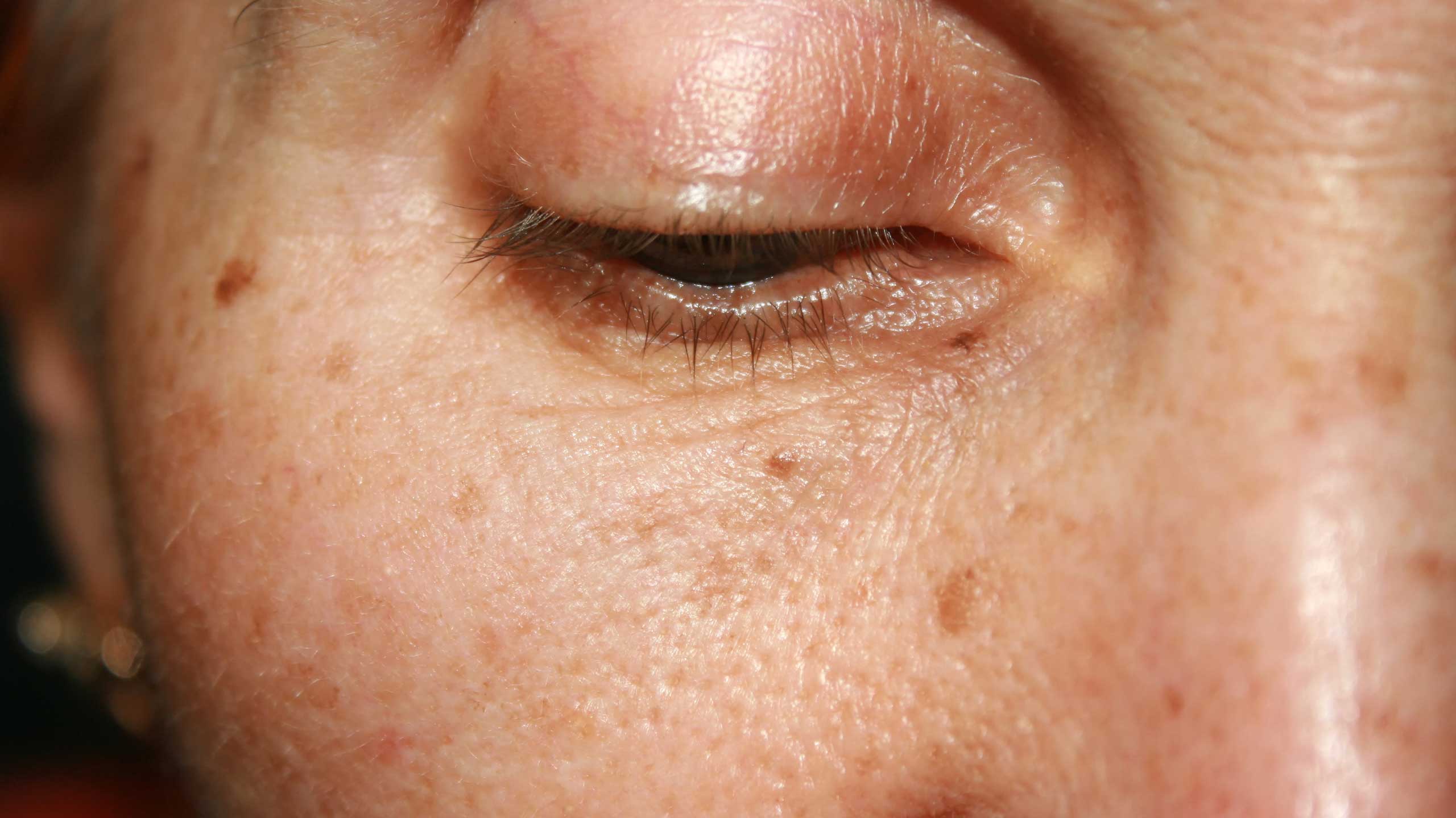 What causes Sun Damage and what treatments are there?