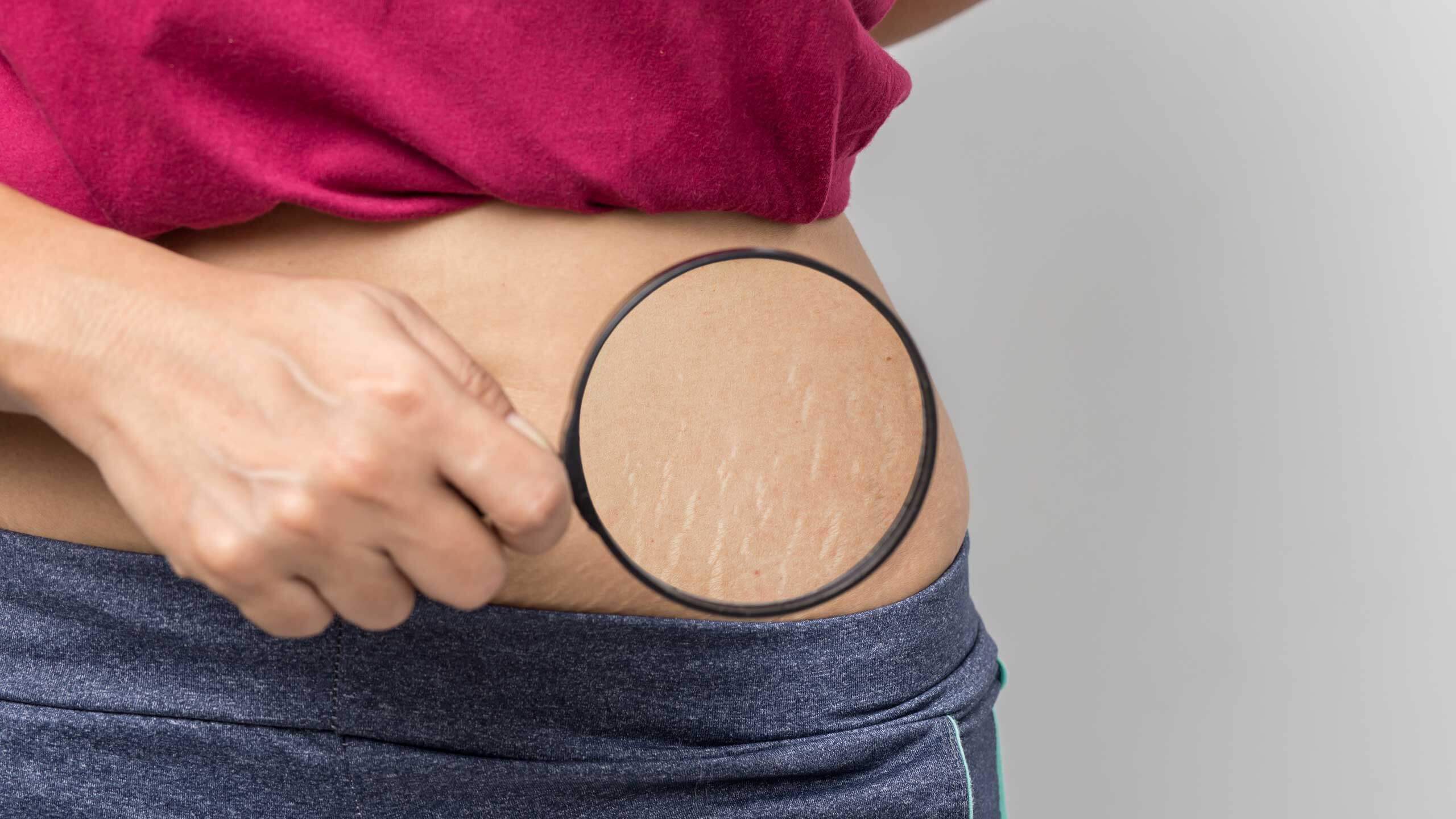 What causes Stretch Marks and what treatments are there?