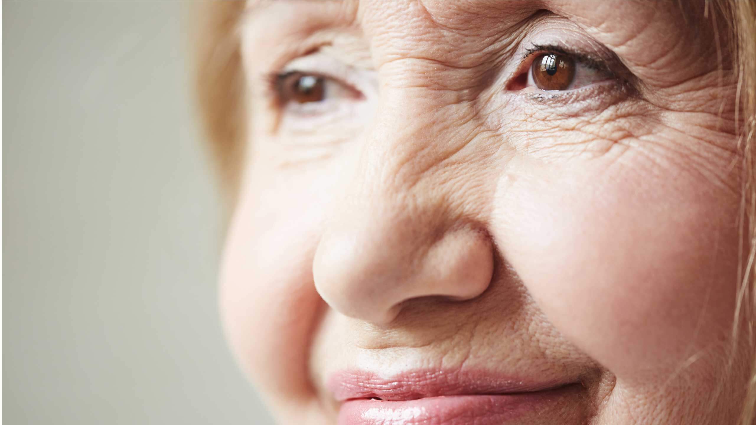 What causes Laughter Lines and what treatments are there?