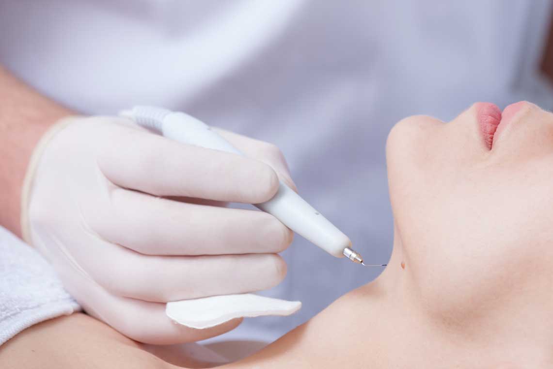 Wart Removal treatment Wolverhampton | Walsall
