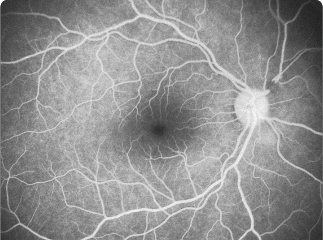 ICON Retinal Imaging System