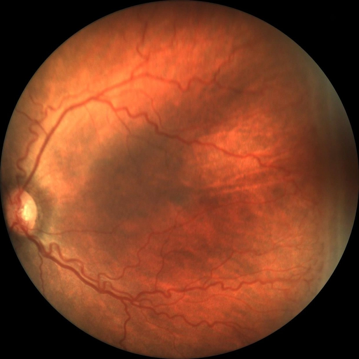 ICON Retinal Imaging System