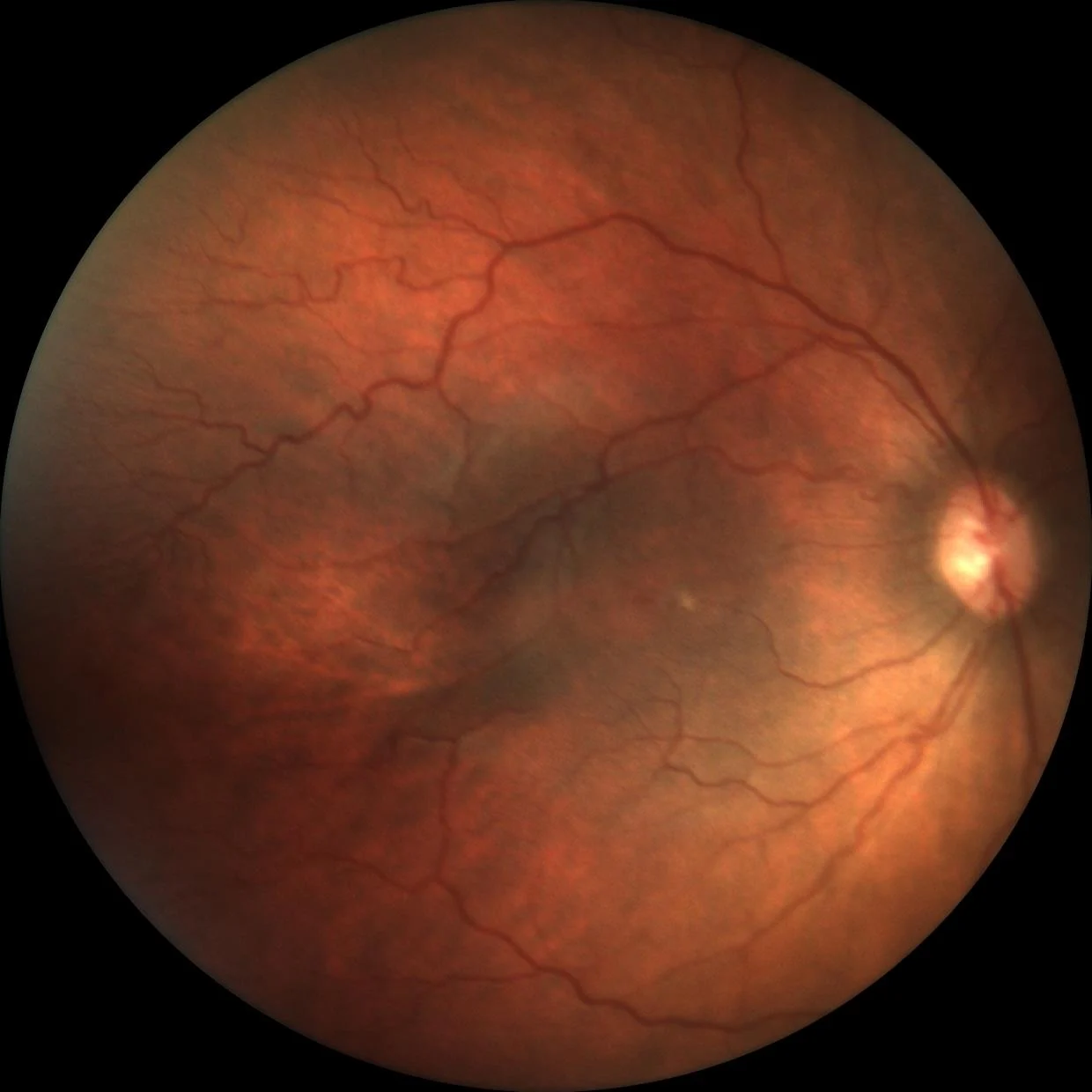 ICON Retinal Imaging System