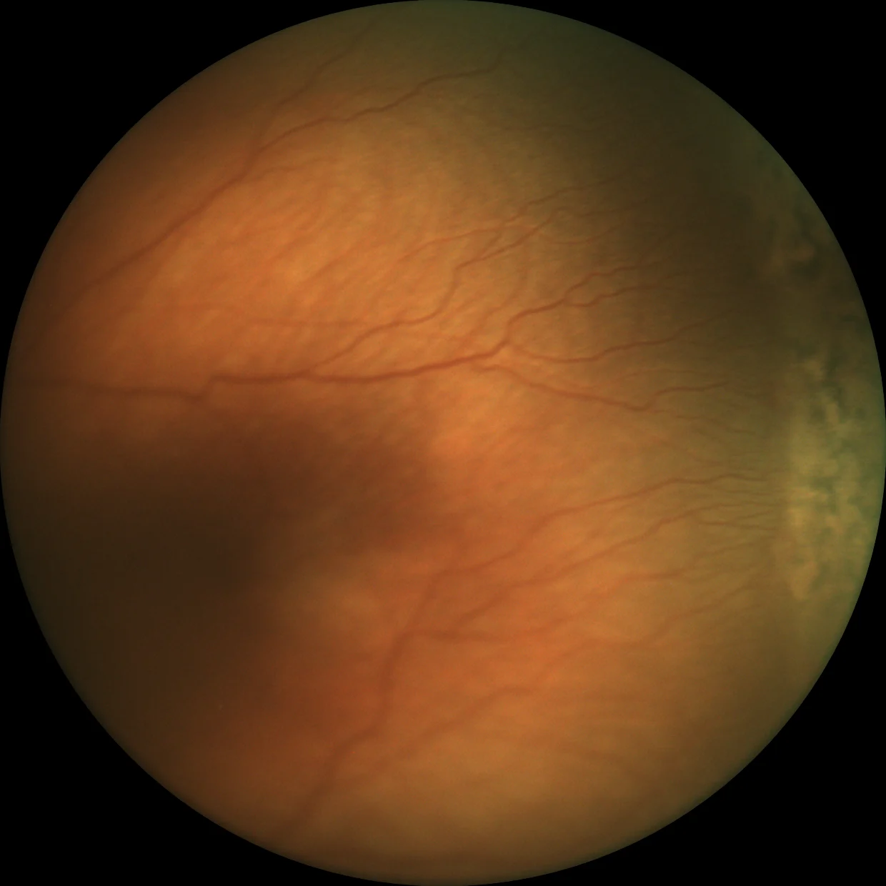 ICON Retinal Imaging System