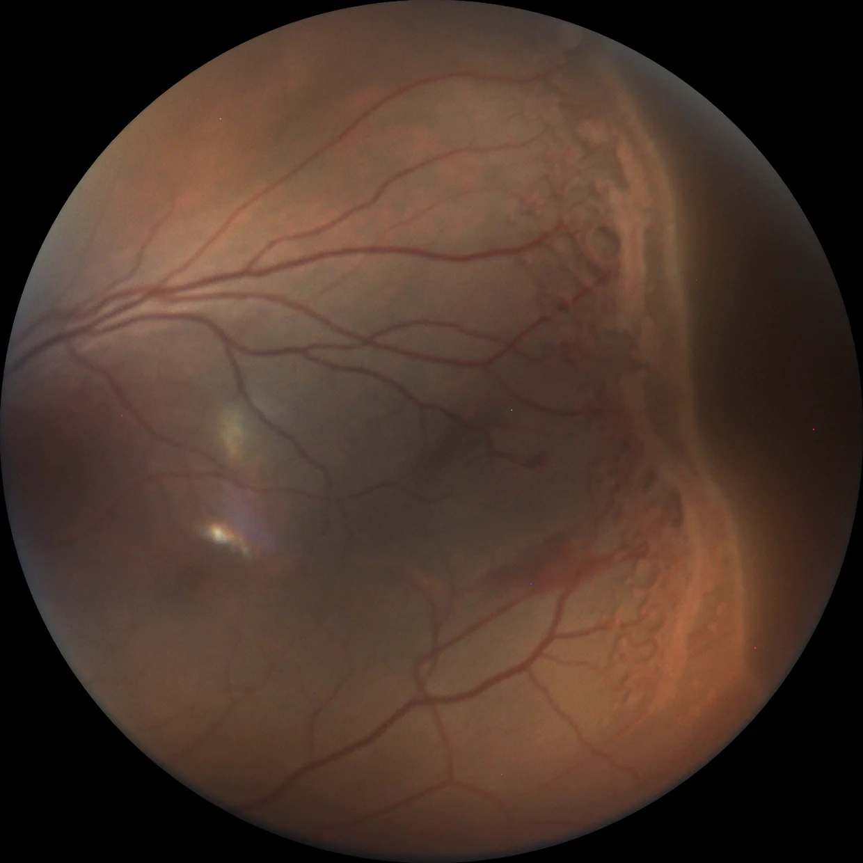 ICON Retinal Imaging System