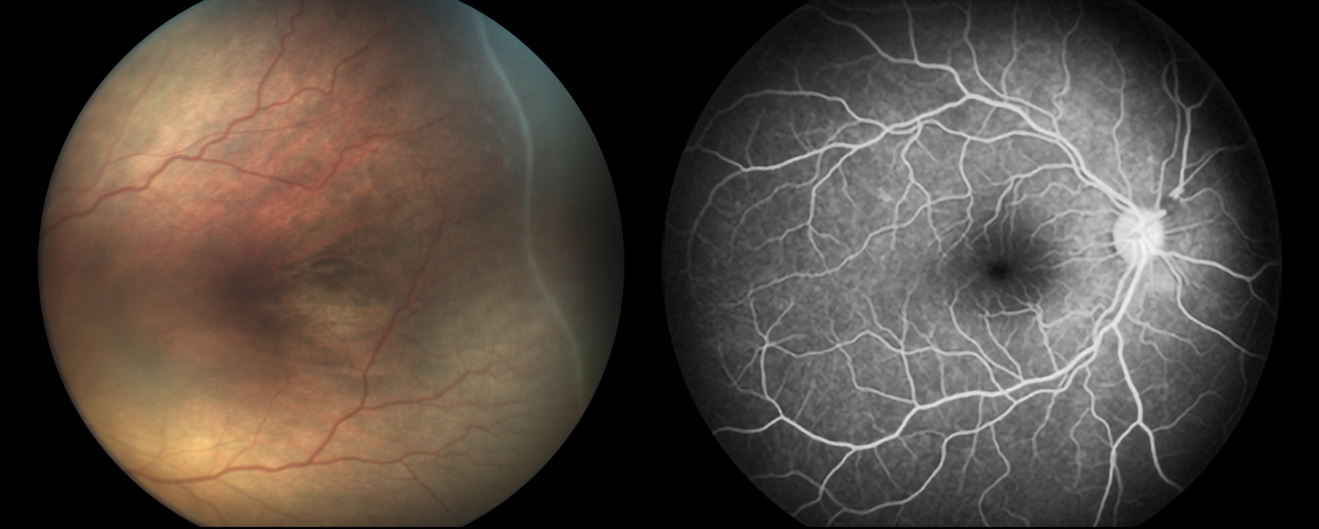 ICON™ GO Becomes the World's Only Portable FDA-Cleared Retinal Imaging ...