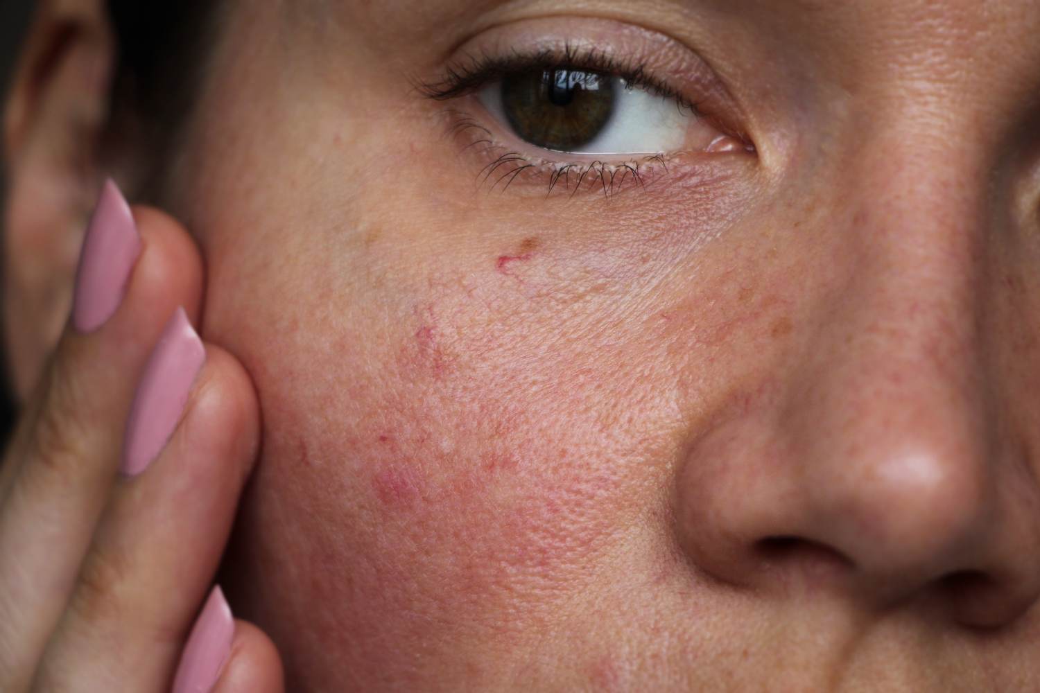 Facial Redness Veins Victorian Dermal Group