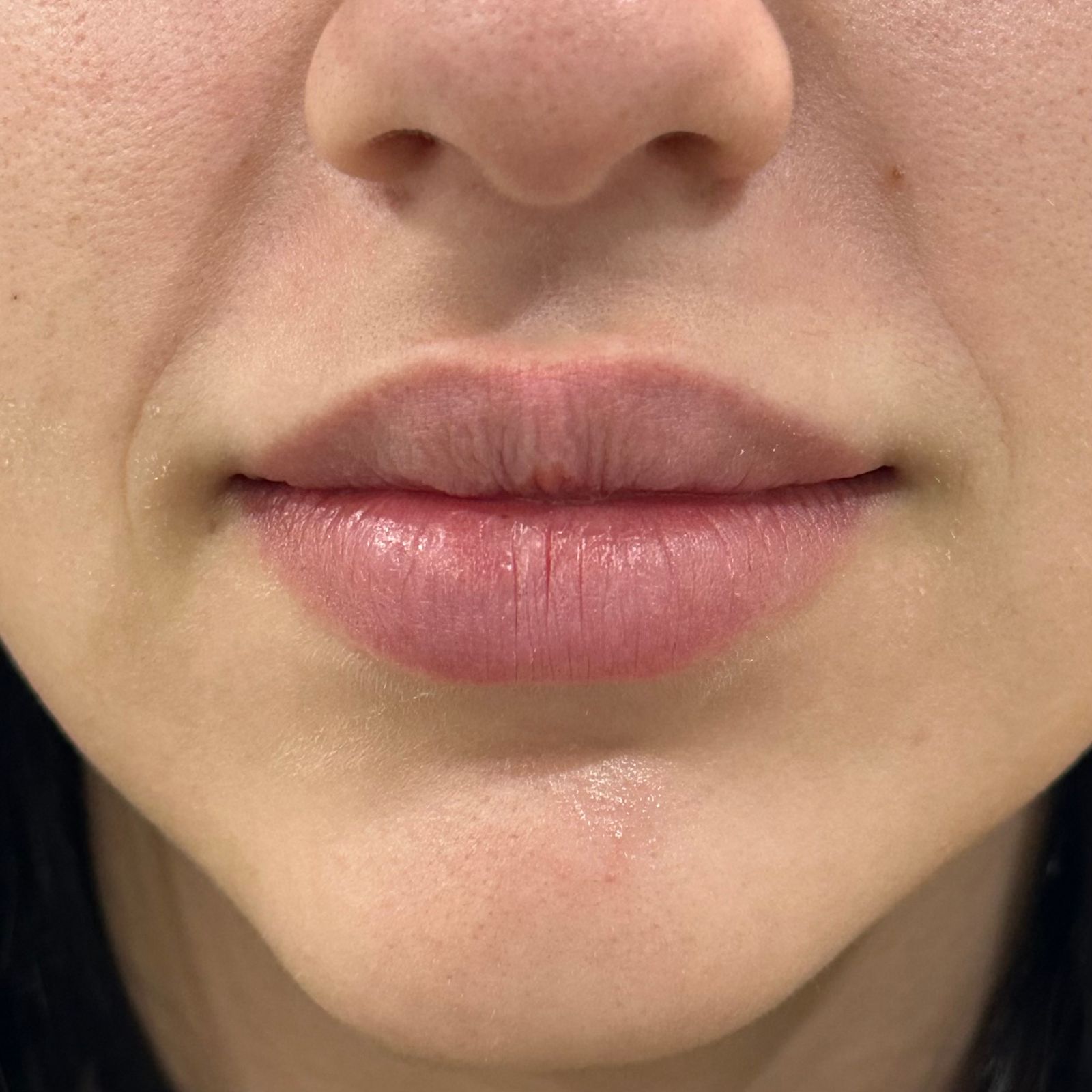 Lip Flip Treatments Melbourne | Gentle Lip Flip for Fuller Lips