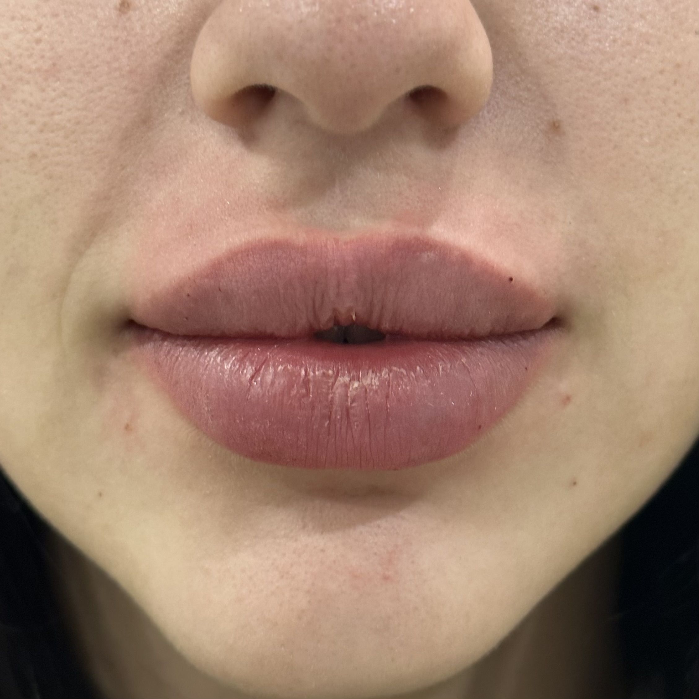 Lip Flip Treatments Melbourne | Gentle Lip Flip for Fuller Lips