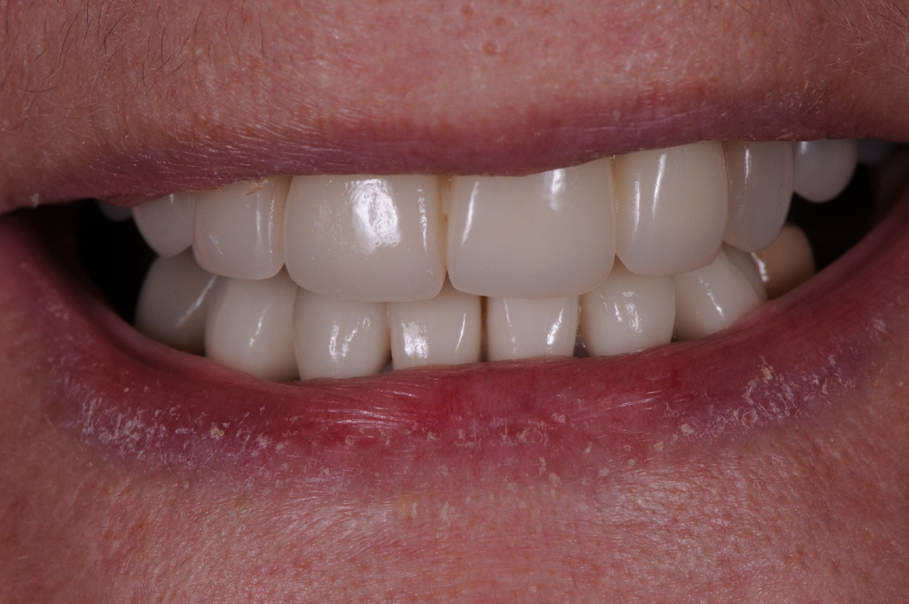 Services: Alternatives to "All on 4" | Brisbane Prosthodontics