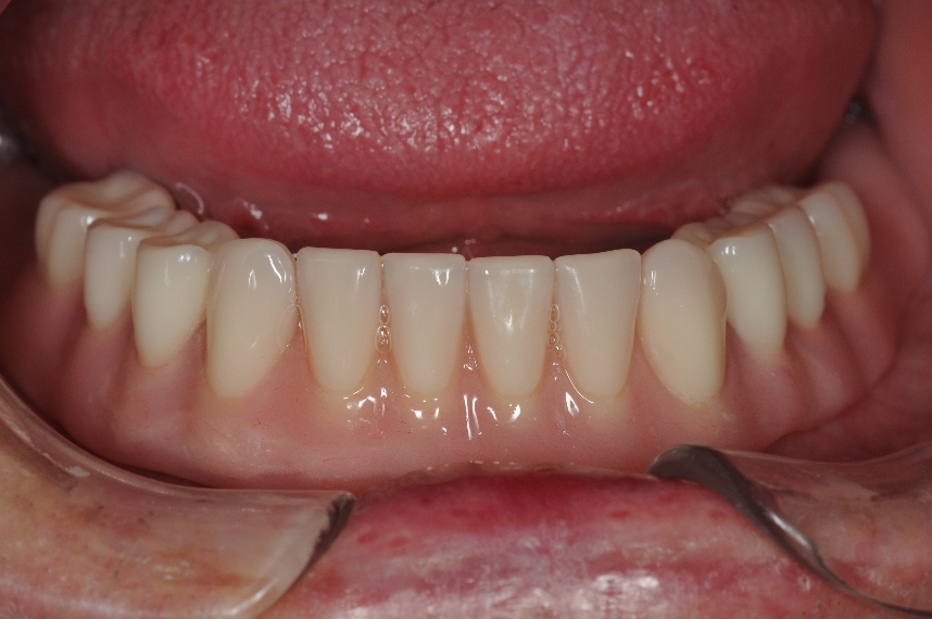Services: Over Dentures | Brisbane Prosthodontics
