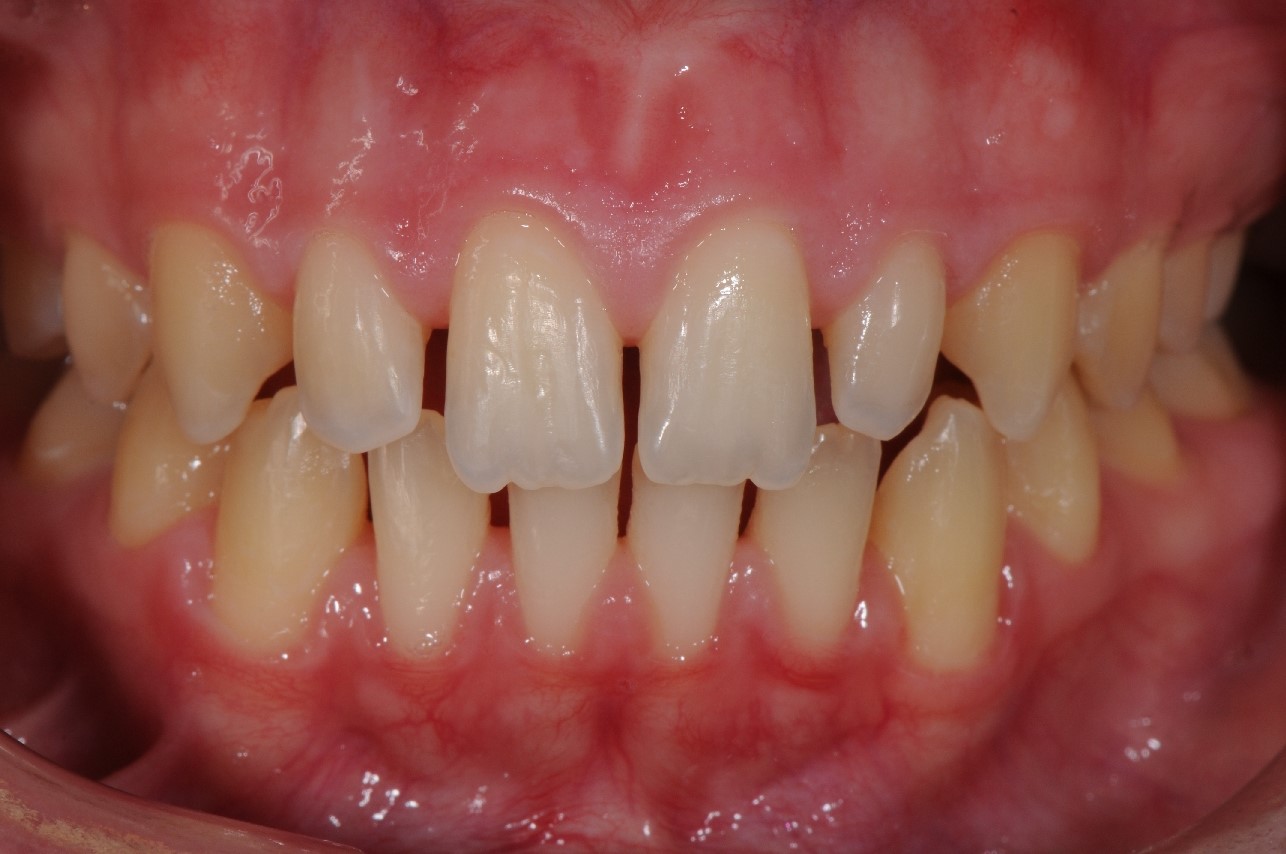 Services: Restoring Front Teeth | Brisbane Prosthodontics