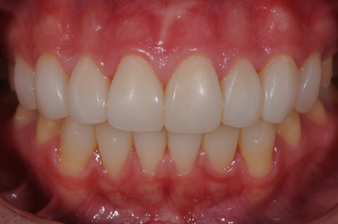 Services: Restoring Front Teeth | Brisbane Prosthodontics
