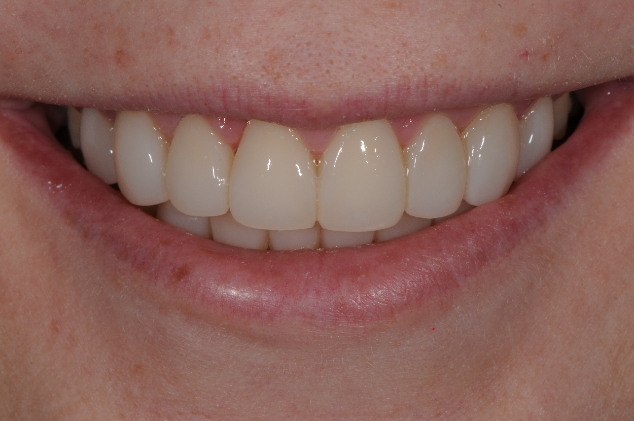 Services: Restoring Front Teeth | Brisbane Prosthodontics