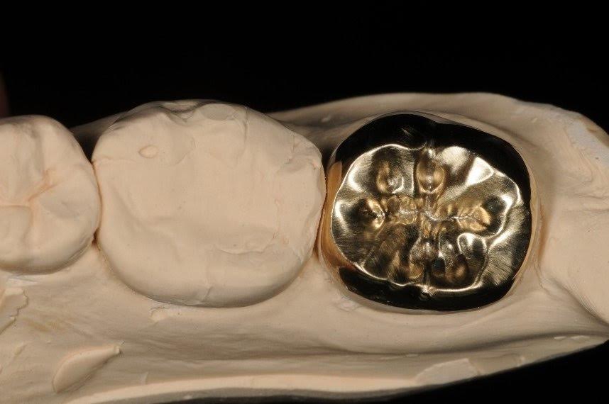 Services: Gold Crowns | Brisbane Prosthodontics