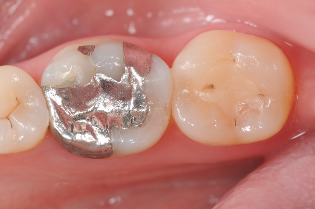 Services: Gold Crowns | Brisbane Prosthodontics