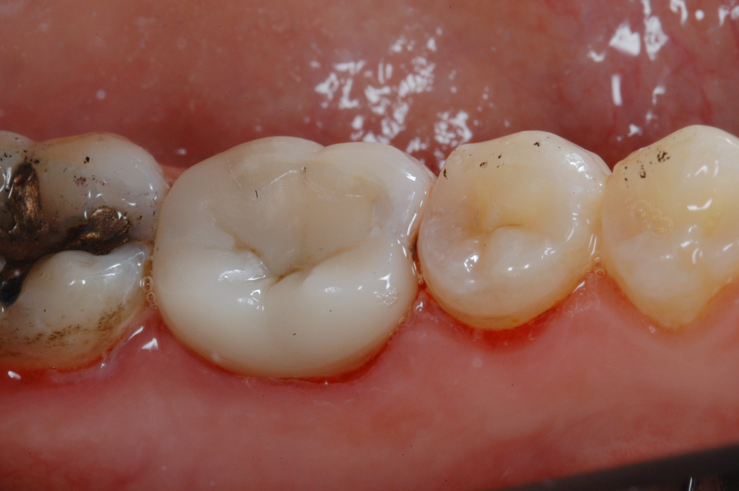 Services: Restoring Molar Teeth | Brisbane Prosthodontics