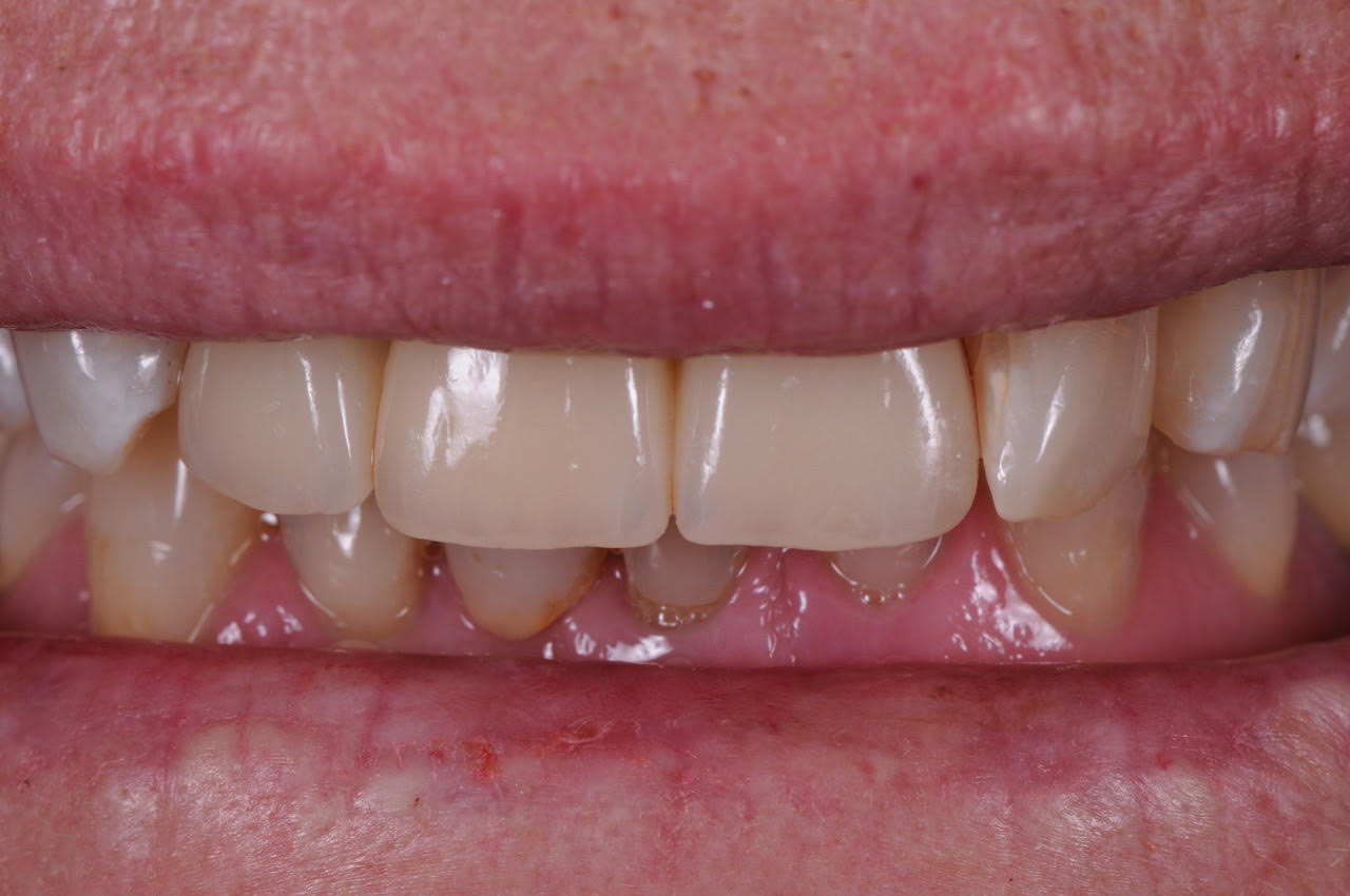 Services: What is a Bridge | Brisbane Prosthodontics