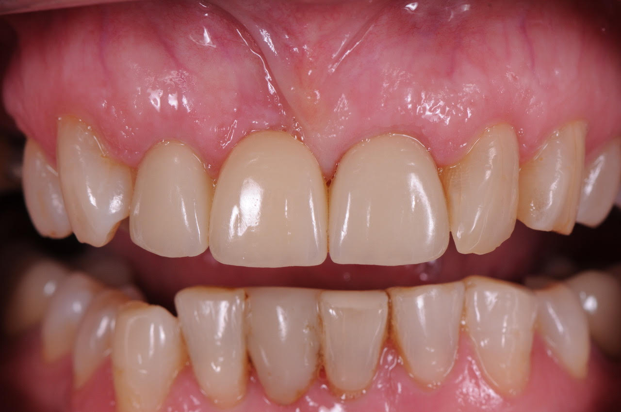 Services: What is a Bridge | Brisbane Prosthodontics