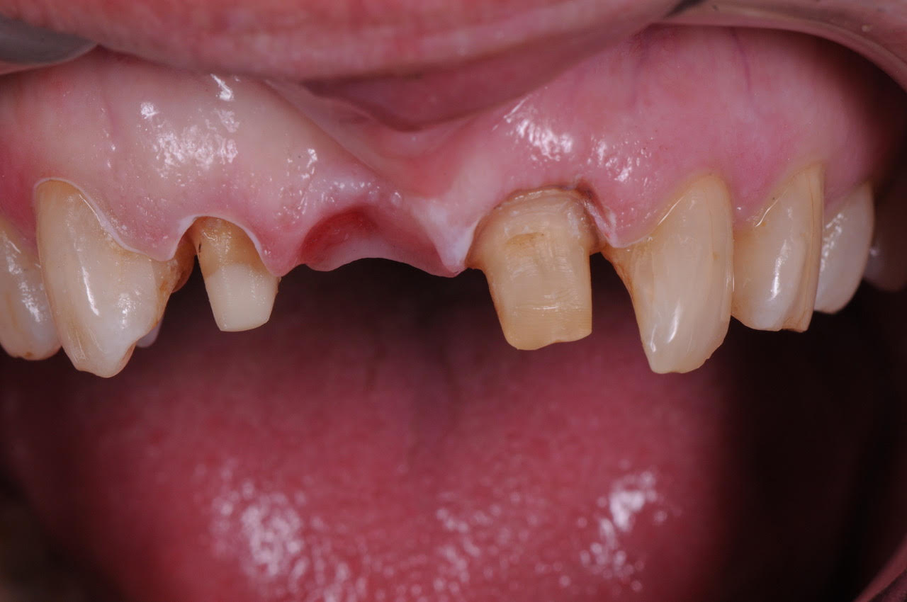 Services: What is a Bridge | Brisbane Prosthodontics