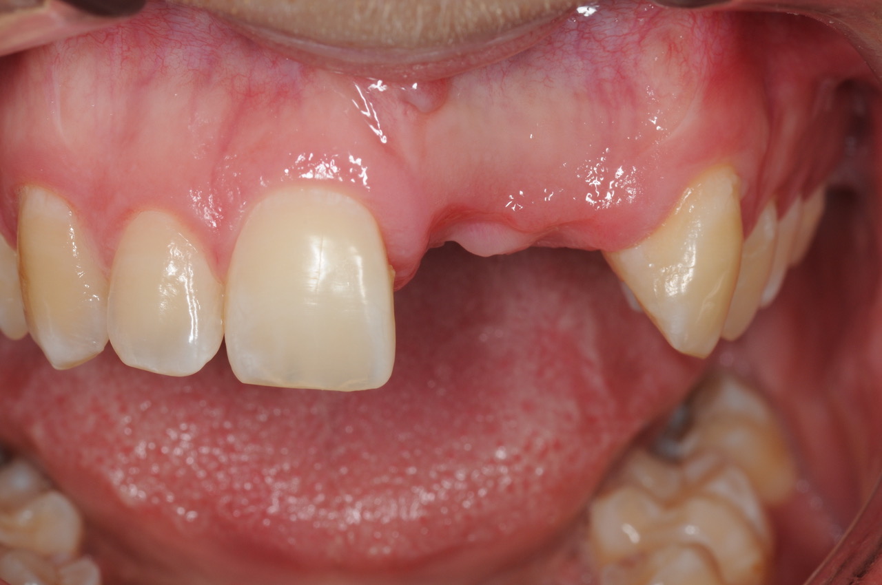 Services: Implant Bridges | Brisbane Prosthodontics