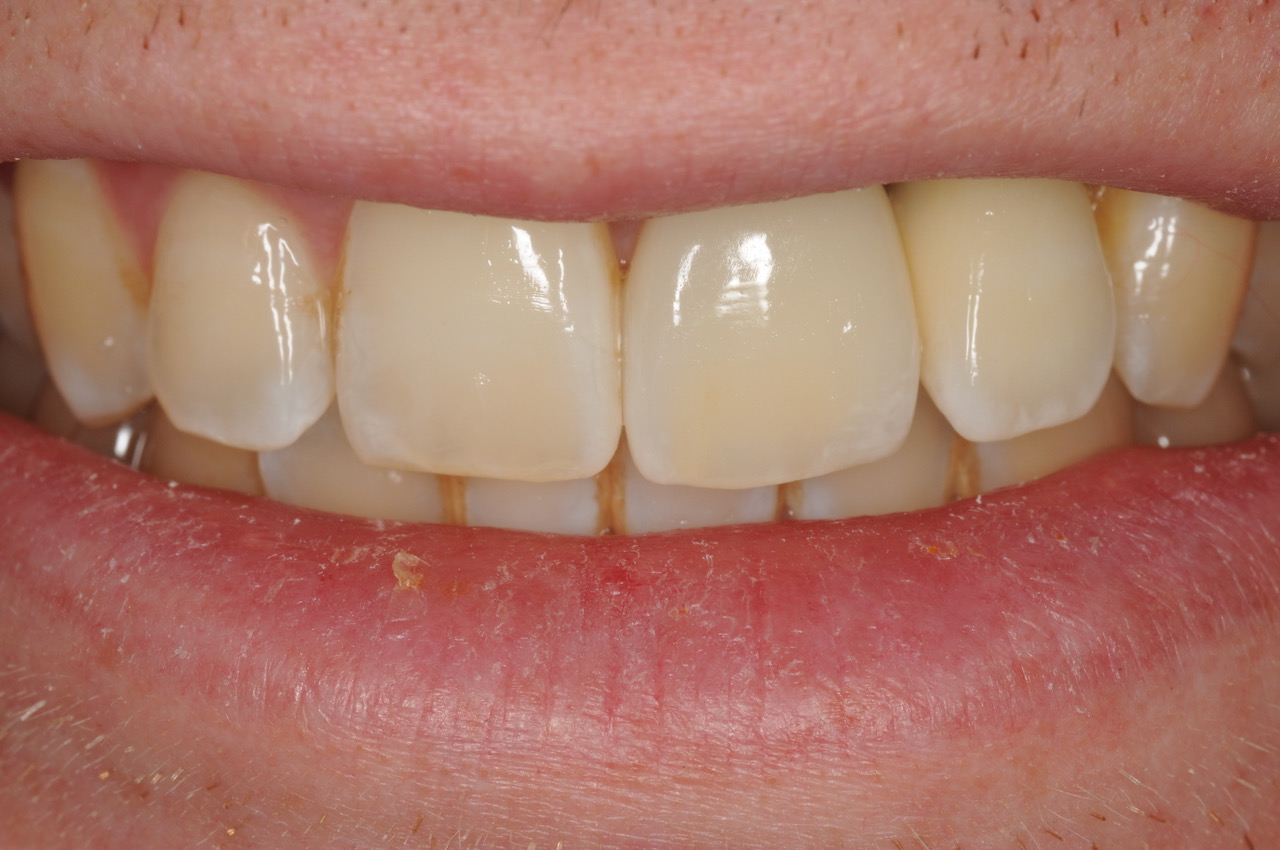 Services: Implant Bridges | Brisbane Prosthodontics