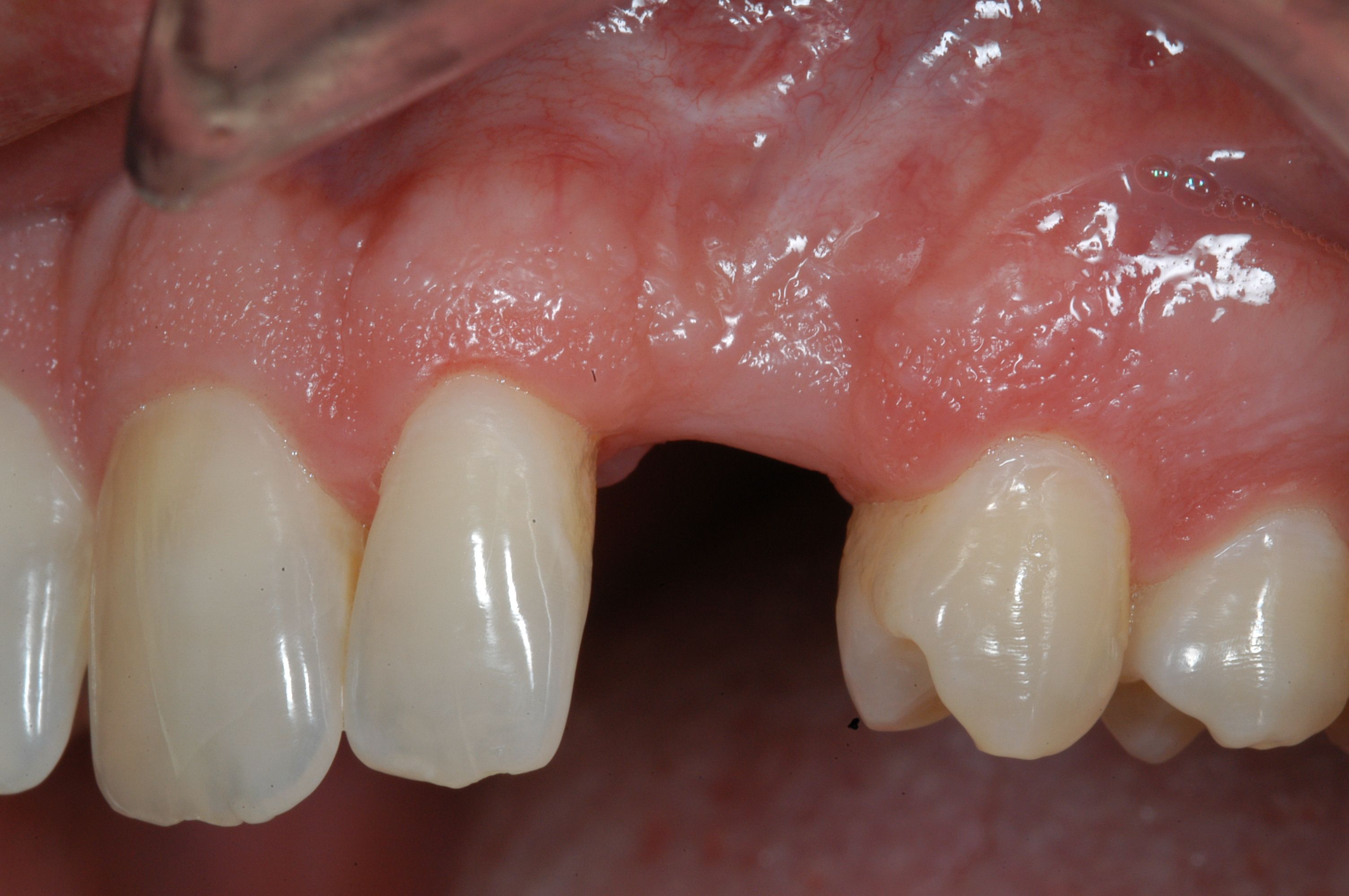 Services: Bonded Bridges | Brisbane Prosthodontics
