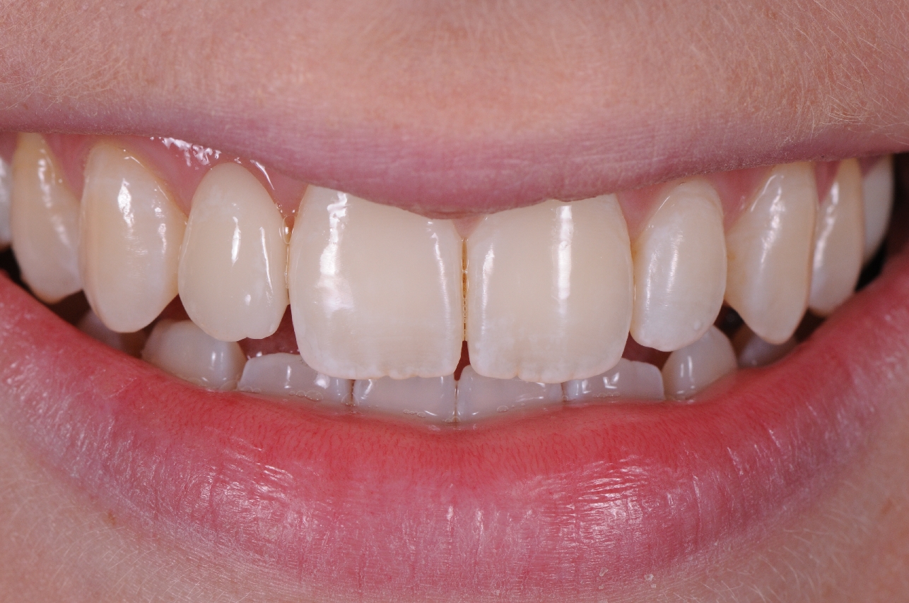 Services: Bonded Bridges | Brisbane Prosthodontics