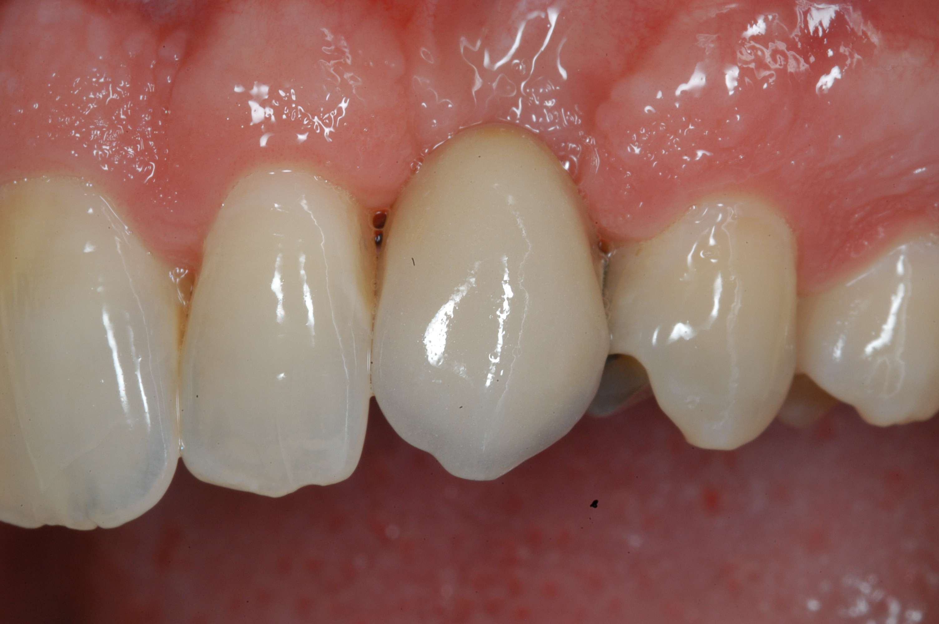 Services: Bonded Bridges | Brisbane Prosthodontics