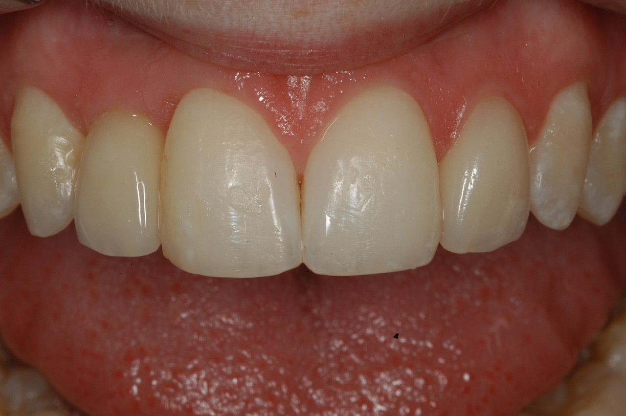 Services: Single Tooth Implants | Brisbane Prosthodontics