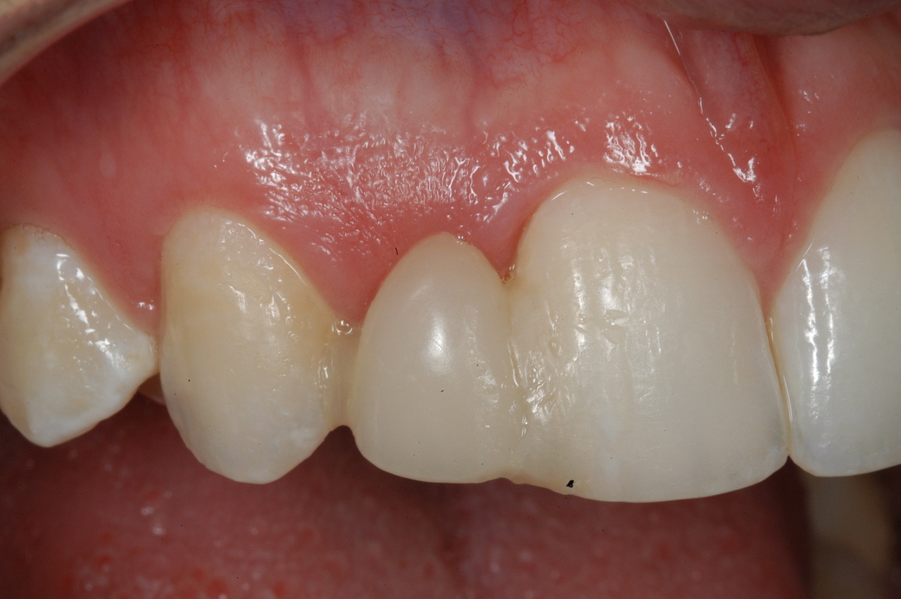 Services: Single Tooth Implants | Brisbane Prosthodontics